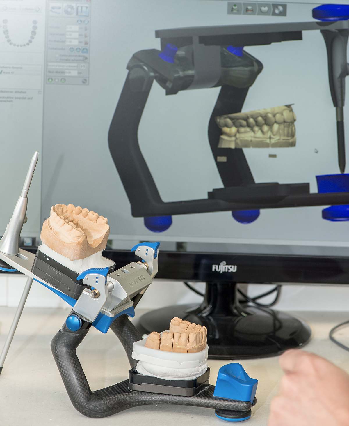 Hilfreiche Entlastung: ProWell-Knirscherschiene zur Therapie von ...